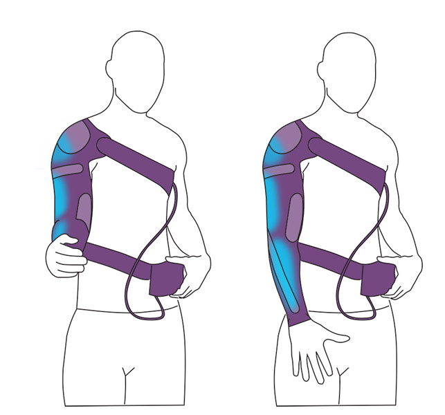 UE BioSleeve – AxioBionics, LLC